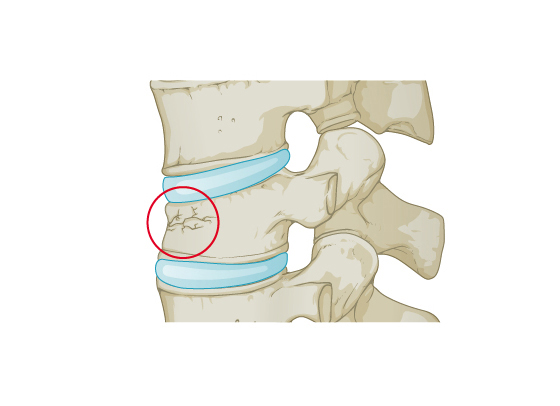 Collapsing fracture of vertebrae