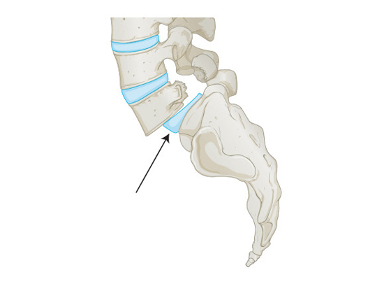 Forward displacement of a vertebra